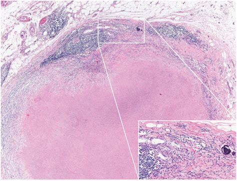 Caseous Necrosis Lymph Node