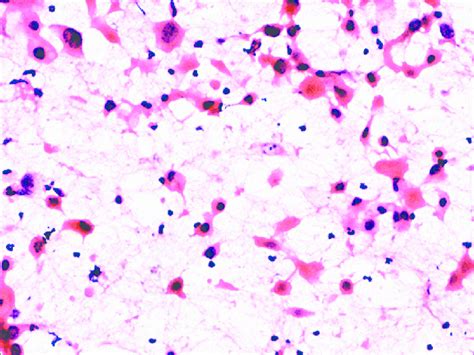 Discrete Population Of Tumor Cells Showing Squamoid Differentiation H Download Scientific