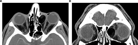 Frontiers Orbital Masses A Review Of Ct Imaging Characteristics