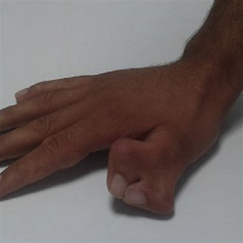 Relationship Between Wassel Classification And Functional Results