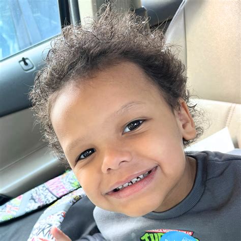 Tspear Related Ectodermal Dysplasia Nfed