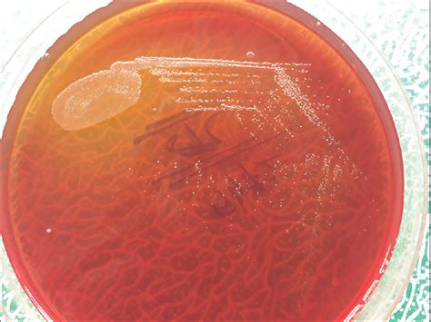 Bacteremia Caused By Comamonas Testosteroni An Unusual Pathogen Journal Of Laboratory Physicians