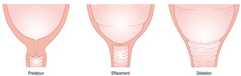 Management Of Labour Clinical Tree