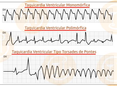 Taquicardia Ventricular Polimórfica