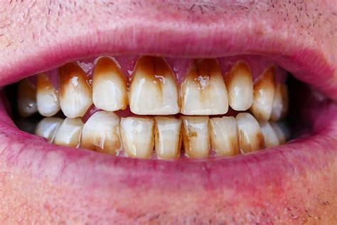 Why Teeth Discoloration Happens Dr Tracey Downtown Dental
