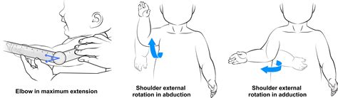 Early Elbow Flexion Contracture Predicts Shoulder Contracture In