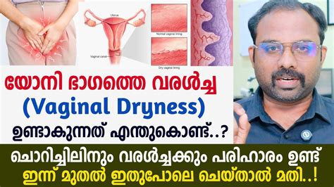 യോനി വരൾച്ചയും ചൊറിച്ചിലും ഉണ്ടാകുന്നത് എന്തുകൊണ്ട് പൂർണമായി എങ്ങനെ