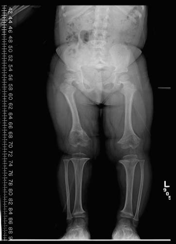 Achondroplasia X Ray Vs Normal