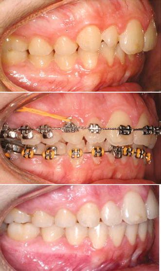 Distal En Masse Retraction Applied Using Elastic Chain Stretched From Download Scientific