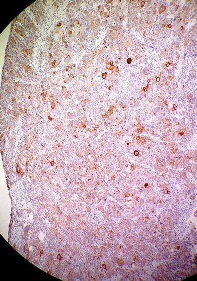 Pleomorphic Carcinoma Of The Breast Case 3 Core Biopsy Bosnianpathology