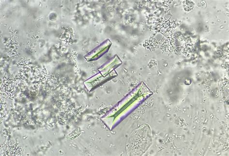 Bacteria In Urine Under Microscope