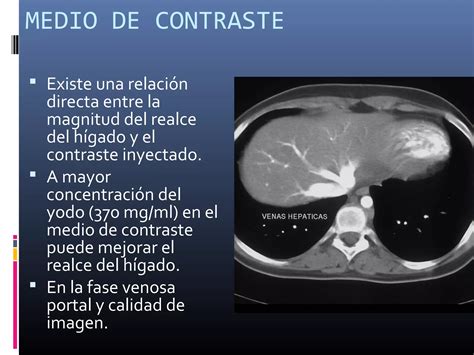 Tomografia Multidetector Del Higado Pot