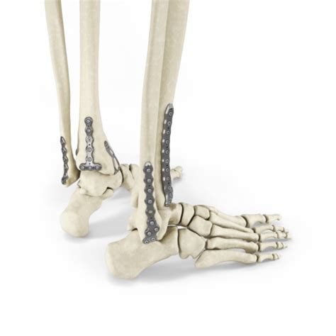 Enovis™ Formerly Branded Djo® Introduces Arsenal Ankle Plating System