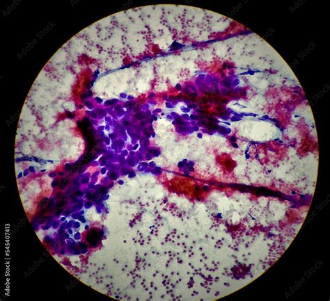 Intra Abdominal Mass Cytology Spindle Cell Sarcoma Positive