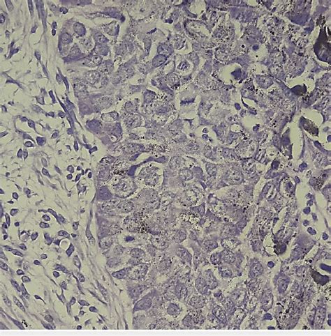 Epithelial Tumor Cells Are Basaloid With A Pleomorphic Nucleus