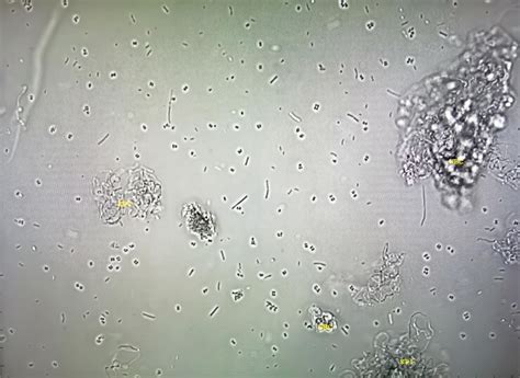 Premium Photo Microscopic Image Of Abnormal Urinalysis Urine Exam