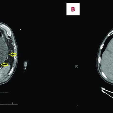 A Ct Scan At Admission Showing Hpvg Red Arrows And Gastric Download Scientific Diagram