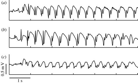 Absence Seizure Eeg Pattern At Corazon Stafford Blog