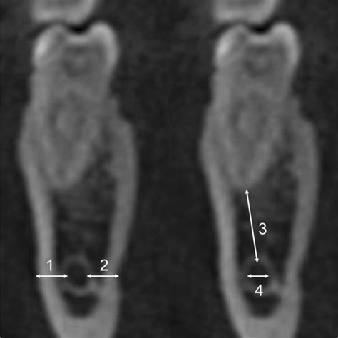 Linear Measurements Obtained From Cone Beam Computed Tomography