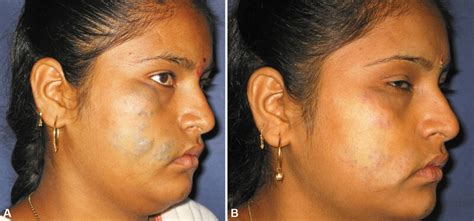 Venous Malformation Before And After Four Ndyag Download Scientific Diagram
