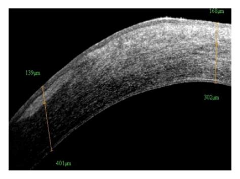 A The Ulcer Was Shown To Involve Approximately 13 Of The Corneal