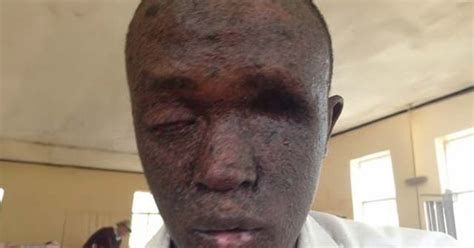 Xeroderma Pigmentosum Image