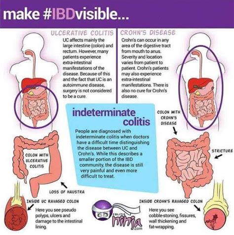 Whats Indeterminate Colitisic Ulcerative Colitisuc And Crohns