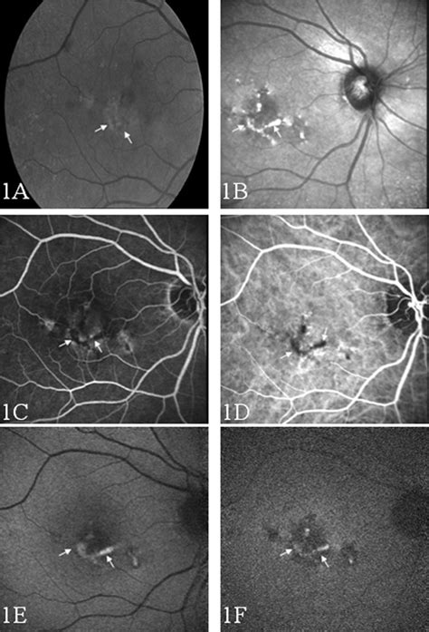 Case 1 Pigment Condensations In Dry Amdpattern Dystrophy A Fundus