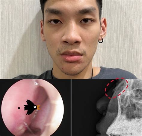 林鴻穎醫師隆鼻 功能性隆鼻功能性隆鼻｜拯救運動挫傷的創傷鼻