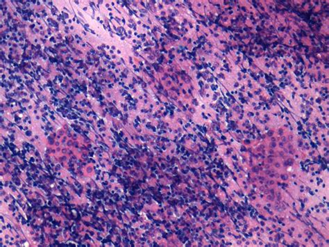 Lymphocytic Thyroiditis