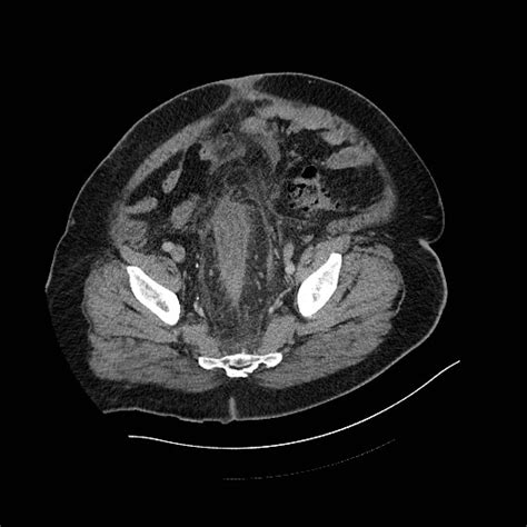 Radiopaedia Case Proctosigmoiditis Id 77266 Study 89330 Nc Commons