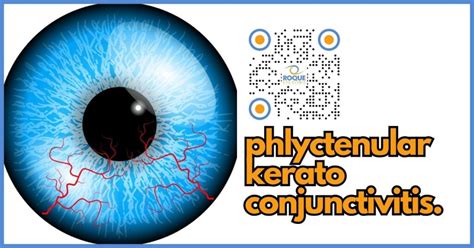 Phlyctenular Keratoconjunctivitis A Comprehensive Guide For Patients
