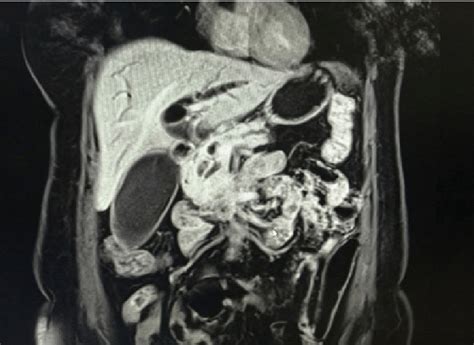 Mri Showing Gallbladder Hydrops Secondary To An Obstructing Lesion Download Scientific Diagram