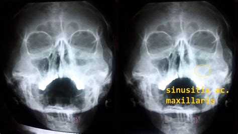 Sinus Infection X Ray Caption Update