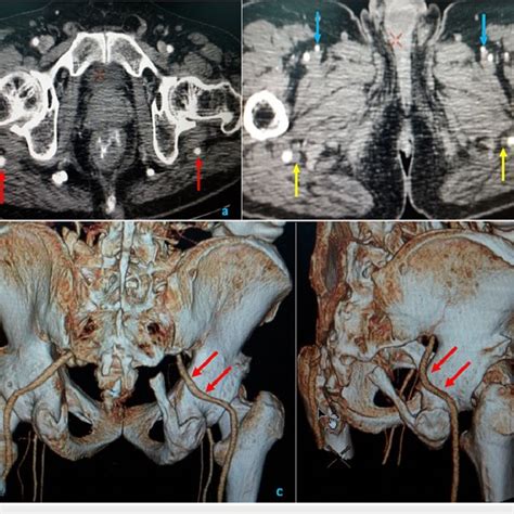 A Persistent Sciatic Artery In A 40 Year Old Male Patient Ct Angiogram
