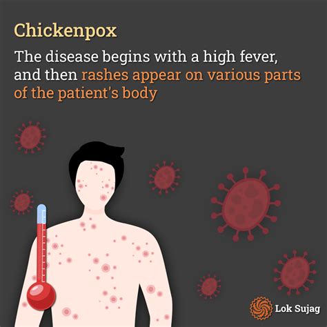 Chickenpox Outbreak Spreads In Chitral Health Officials Scramble To Control Contagion