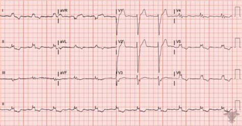 Left Bundle Branch Block Ecg Stampede