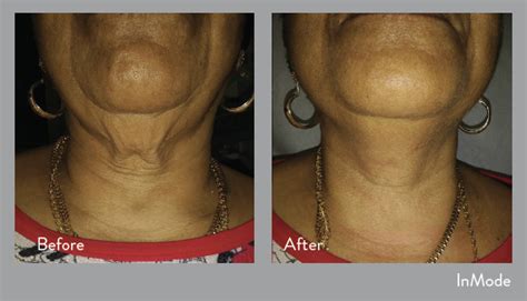 Introducing New Wellness Treatments At Sphere Sphere Optometry Eye Doctor In Southeast Calgary