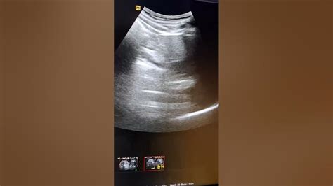 Acute Cholecystitis With Cholelithiasis And Gb Sludge Ultrasound Youtube