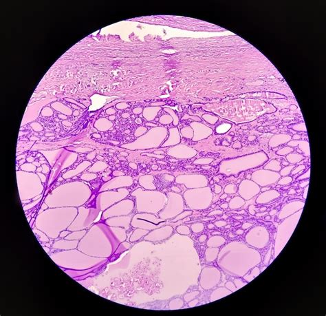 Premium Photo Synovial Sarcoma Histology Image Analyzed By Microscope At Histopathology
