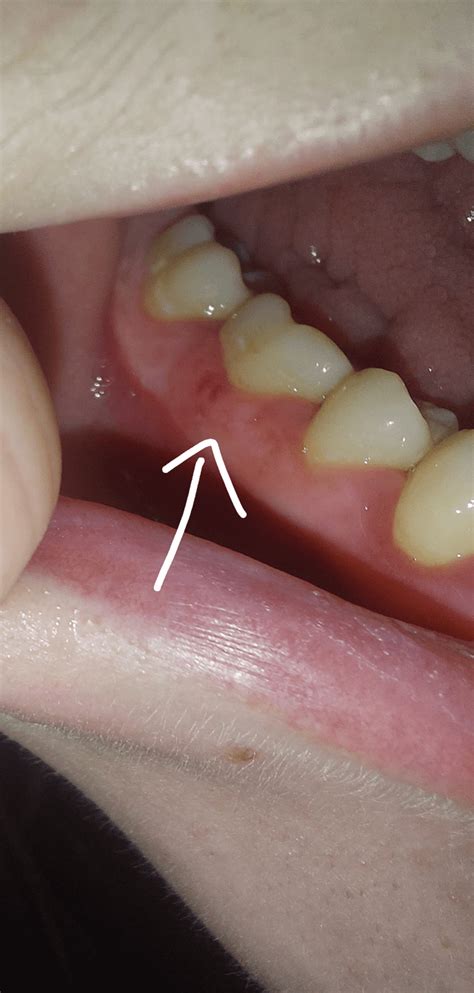 Weird Red Spot On My Gums What Is It Raskdentists