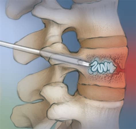 Vertebral Augmentation — Learn Ir