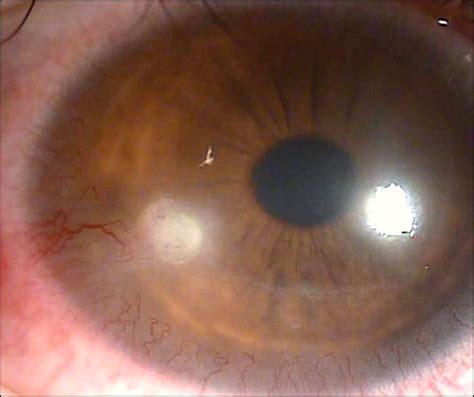 Phlyctenular Keratitis