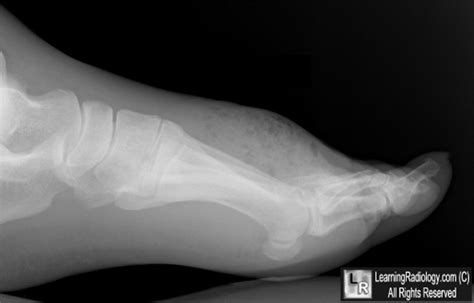Necrotising Fasciitis Xr