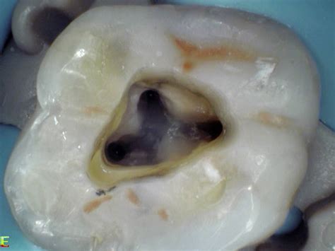 Upper Molar Root Canal