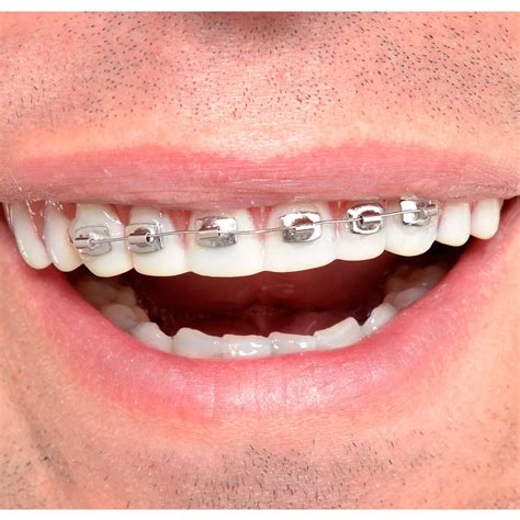 Diy Fake Braces
