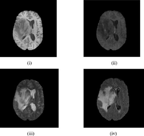 Sample Mri Slice Images With Different Modalities From Brats2020