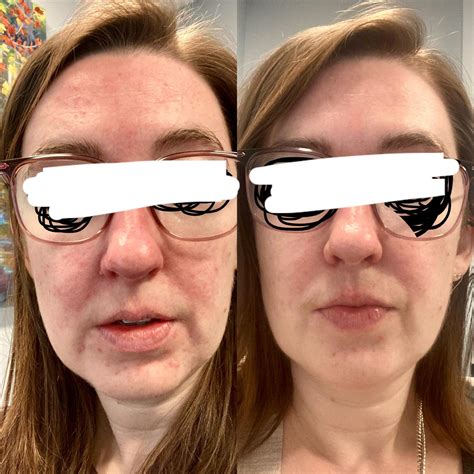 Triple Cream Success Rrosacea