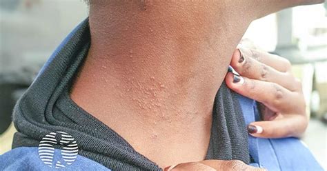 Allergic Contact Dermatitis Image