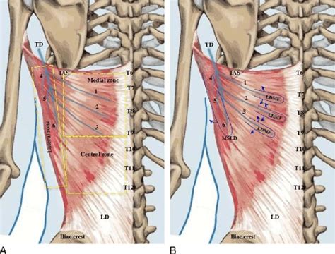 A Diagrammatic Illustration Of Type 1 Td Pedicle It Covers Mainly